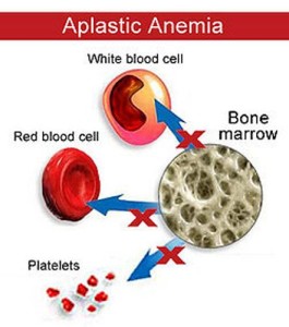 9 Facts about Aplastic Anemia - Fact File